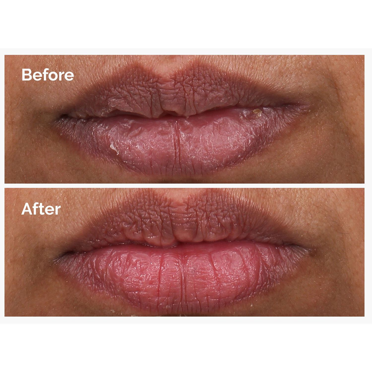 PHA 5% Exfoliating Lip Serum, Peeling Serum für die Lippen - The ...
